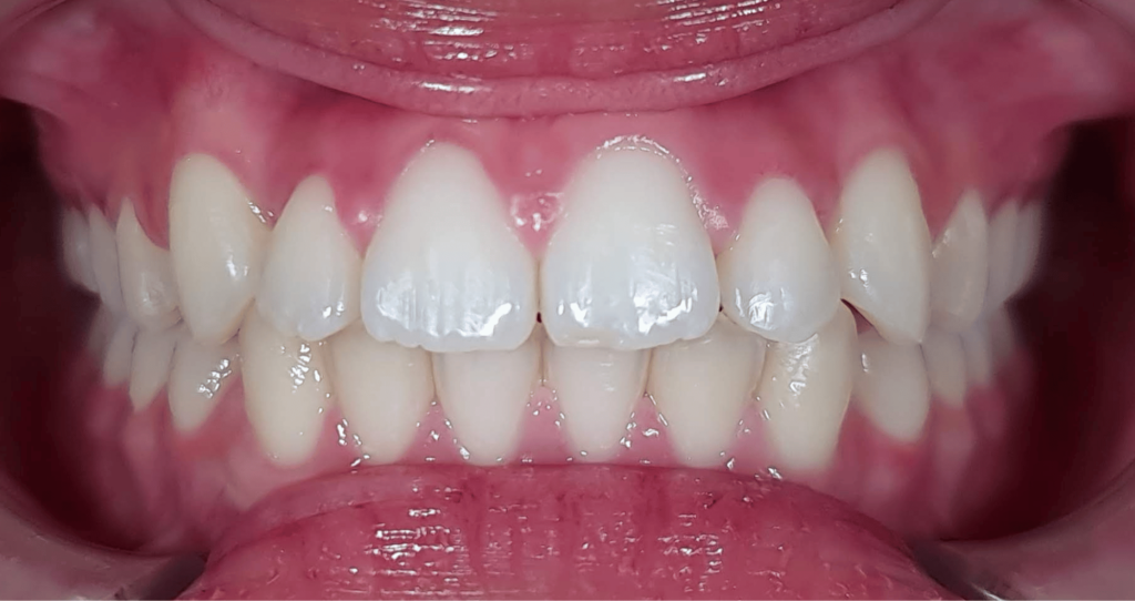 Behel Damon / Kawat Gigi Damon | Dokgi Dental Clinic